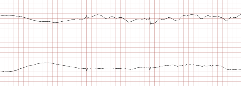 Sudden cardiac arrest: Case 3 – The Cardiovascular