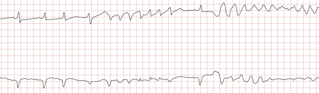 Sudden cardiac arrest: Case 1 – The Cardiovascular