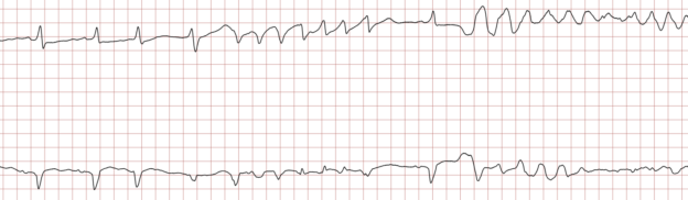 Sudden cardiac arrest: Case 1 – The Cardiovascular