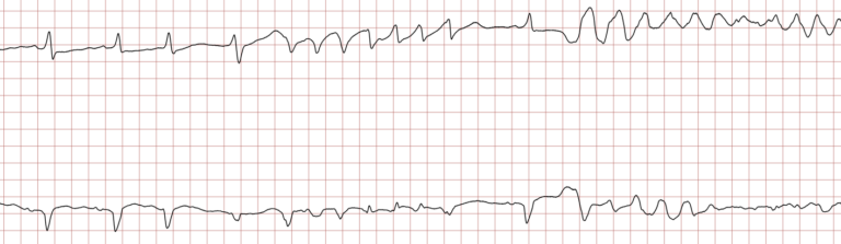 Sudden cardiac arrest: Case 1 – The Cardiovascular