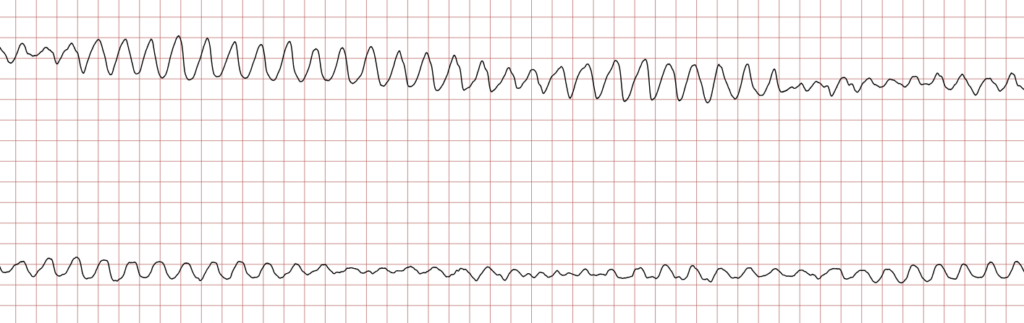 Sudden cardiac arrest: Case 1 – The Cardiovascular