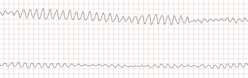 Sudden cardiac arrest: Case 1 – The Cardiovascular