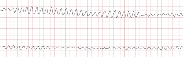 Sudden cardiac arrest: Case 1 – The Cardiovascular