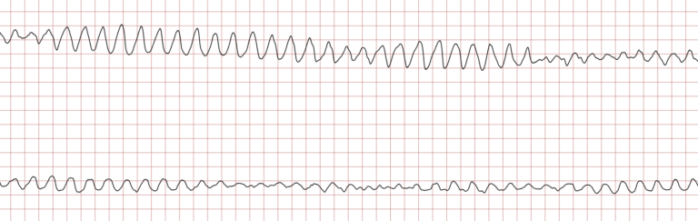 Sudden cardiac arrest: Case 1 – The Cardiovascular