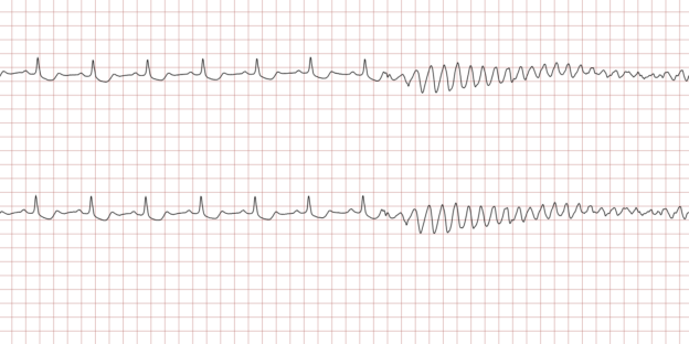 Ventricular fibrillation, pulseless electrical activity and sudden ...
