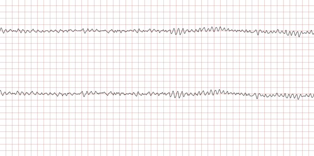 Sudden cardiac arrest: Case 2 – The Cardiovascular