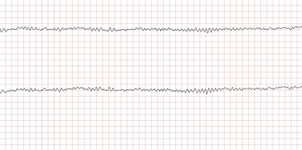 Ventricular fibrillation, pulseless electrical activity and sudden ...