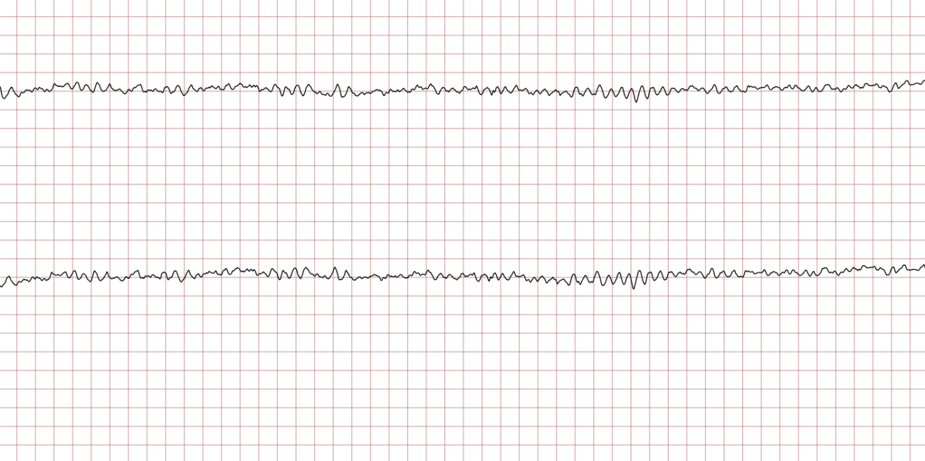 Ventricular fibrillation, pulseless electrical activity and sudden ...