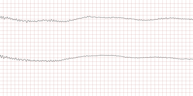 Ventricular fibrillation, pulseless electrical activity and sudden ...