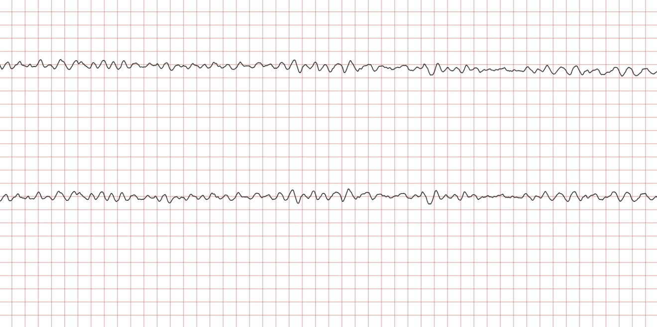Ventricular fibrillation, pulseless electrical activity and sudden ...