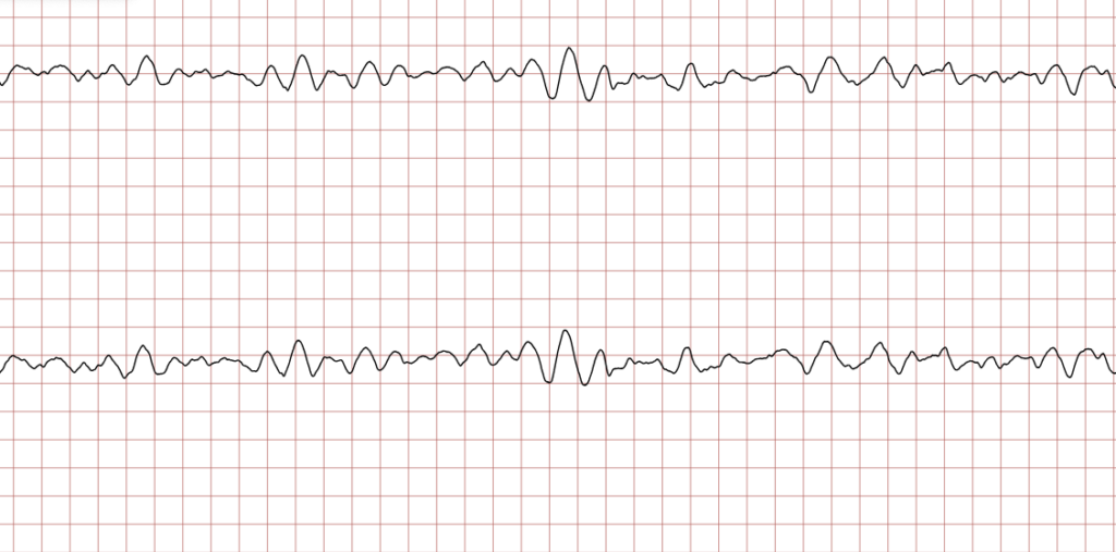Sudden cardiac arrest: Case 2 – The Cardiovascular
