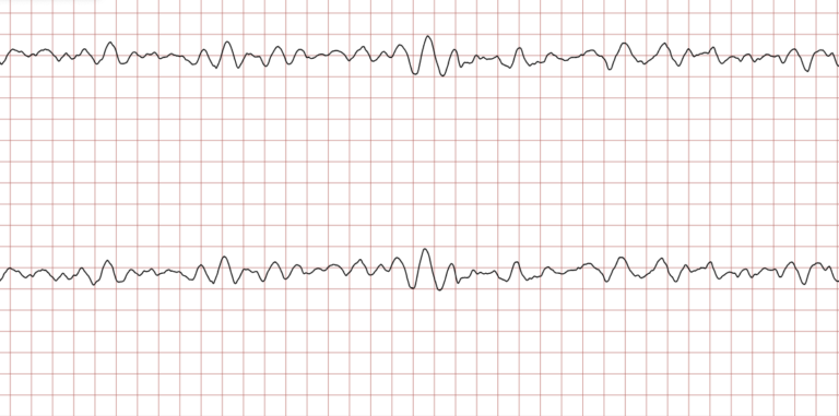 Ventricular fibrillation, pulseless electrical activity and sudden ...