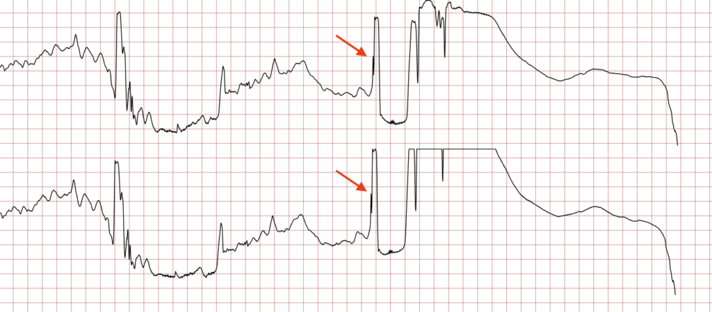 Sudden cardiac arrest: Case 2 – The Cardiovascular