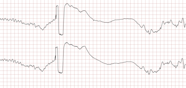 Ventricular fibrillation, pulseless electrical activity and sudden ...