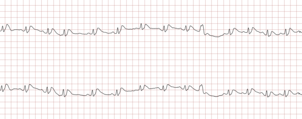 Ventricular fibrillation, pulseless electrical activity and sudden ...
