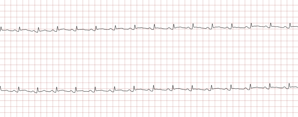 Ventricular fibrillation, pulseless electrical activity and sudden ...