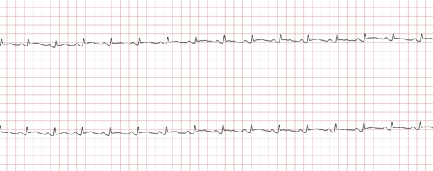 Ventricular fibrillation, pulseless electrical activity and sudden ...