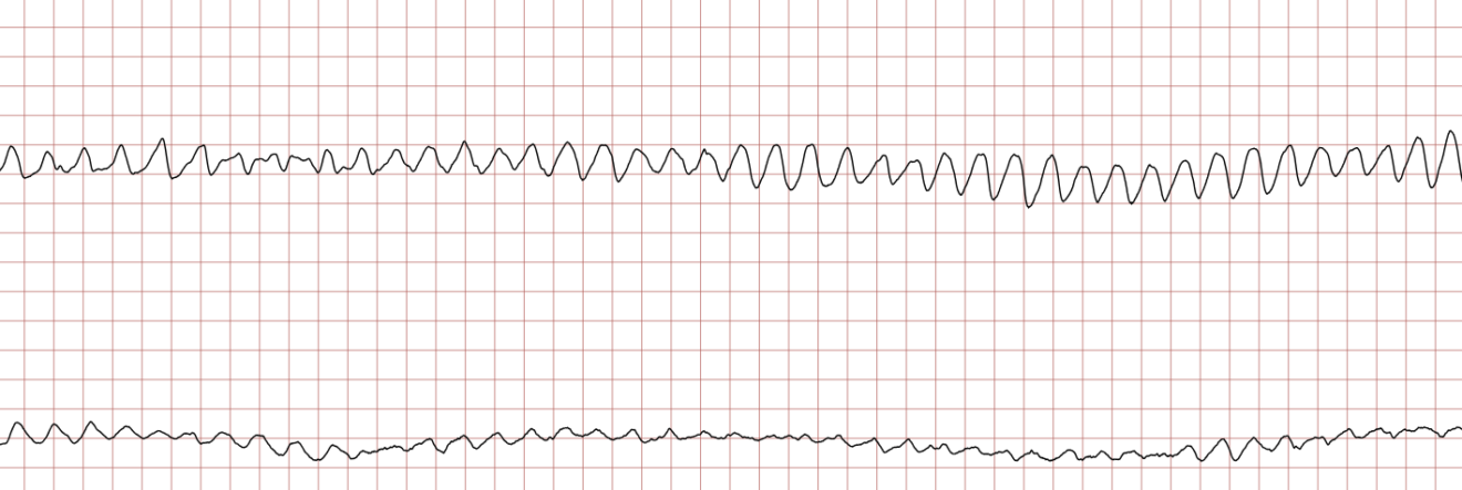 Sudden cardiac arrest: Case 1 – The Cardiovascular