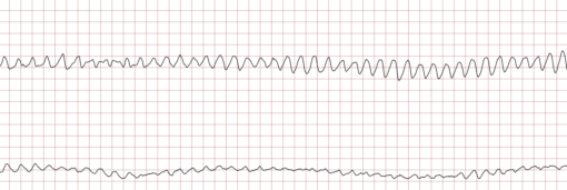 Sudden cardiac arrest: Case 1 – The Cardiovascular