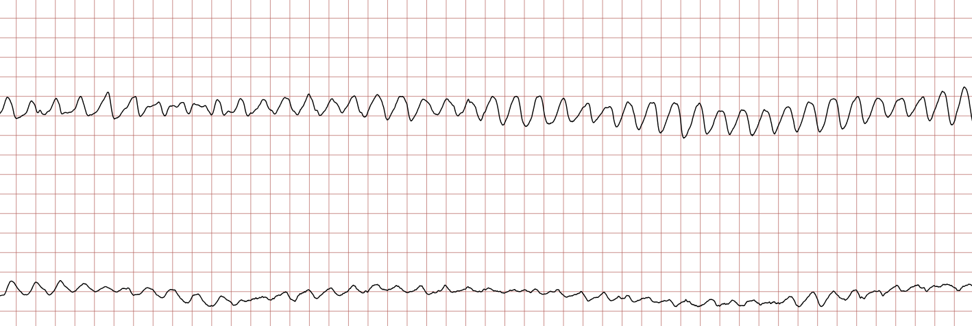 Sudden cardiac arrest: Case 1 – The Cardiovascular