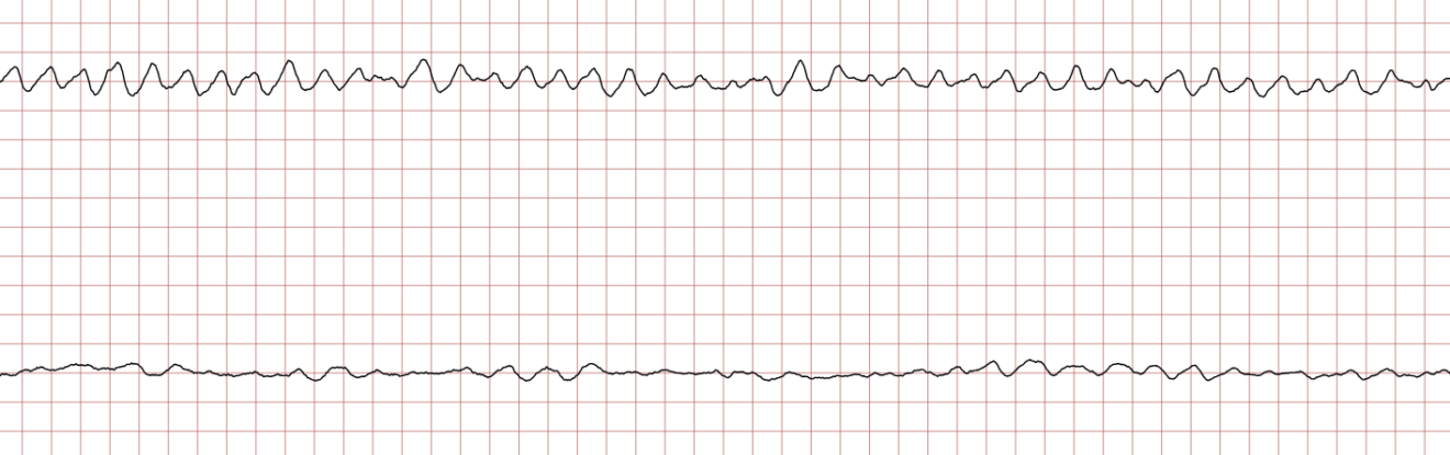 Sudden cardiac arrest: Case 1 – The Cardiovascular