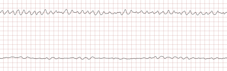 Sudden cardiac arrest: Case 1 – The Cardiovascular
