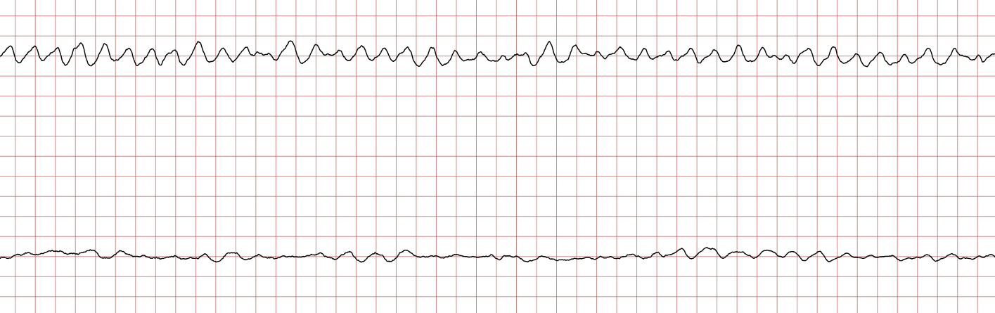 Sudden cardiac arrest: Case 1 – The Cardiovascular