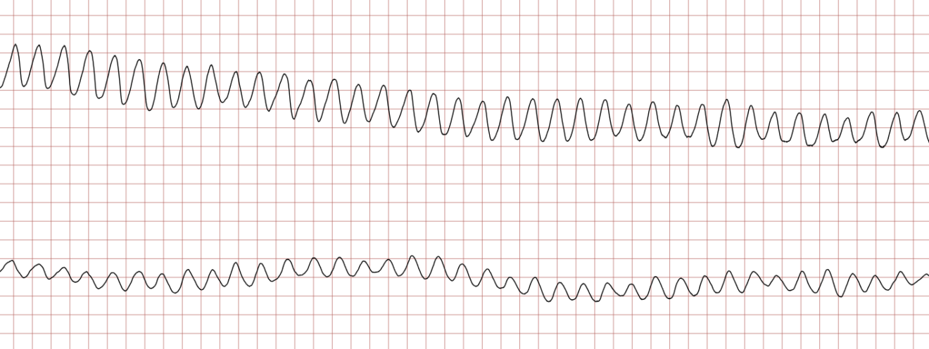 Sudden cardiac arrest: Case 1 – The Cardiovascular