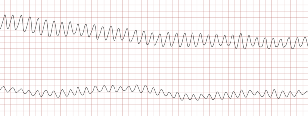 Sudden cardiac arrest: Case 1 – The Cardiovascular