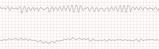 Sudden cardiac arrest: Case 1 – The Cardiovascular