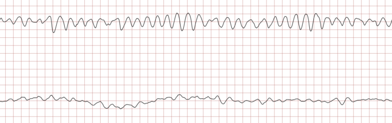 Sudden cardiac arrest: Case 1 – The Cardiovascular