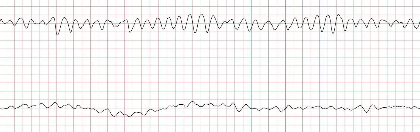 Sudden cardiac arrest: Case 1 – The Cardiovascular