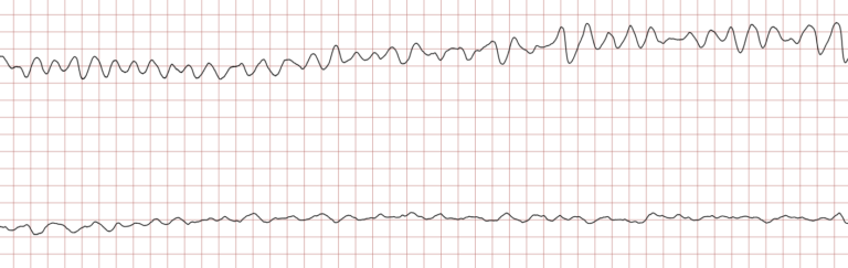 Sudden cardiac arrest: Case 1 – The Cardiovascular