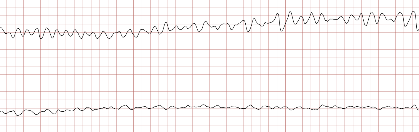 Sudden cardiac arrest: Case 1 – The Cardiovascular