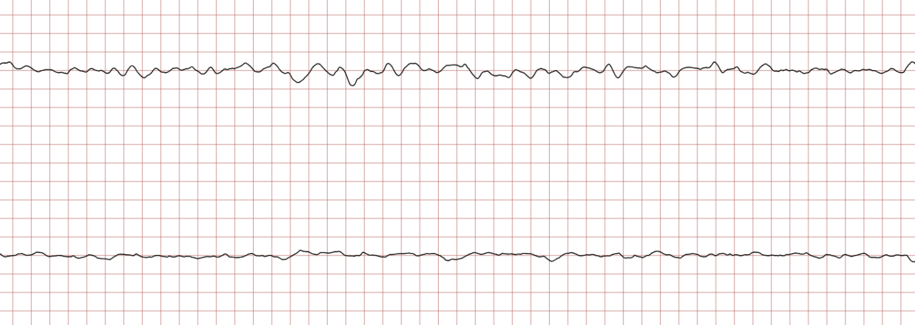 Sudden cardiac arrest: Case 1 – The Cardiovascular