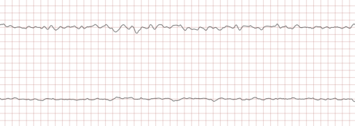 Sudden cardiac arrest: Case 1 – The Cardiovascular