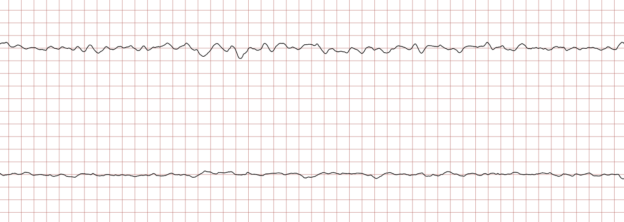 Sudden cardiac arrest: Case 1 – The Cardiovascular