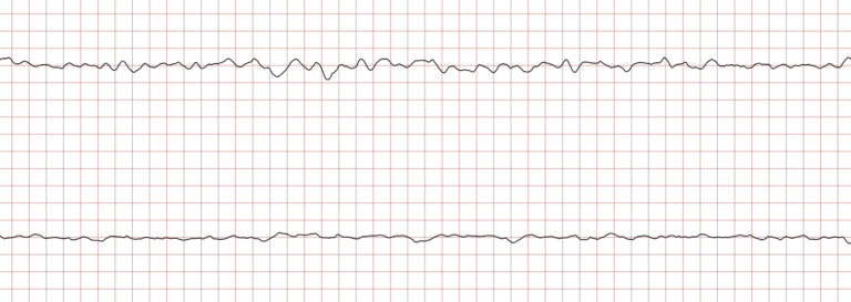 Sudden cardiac arrest: Case 1 – The Cardiovascular