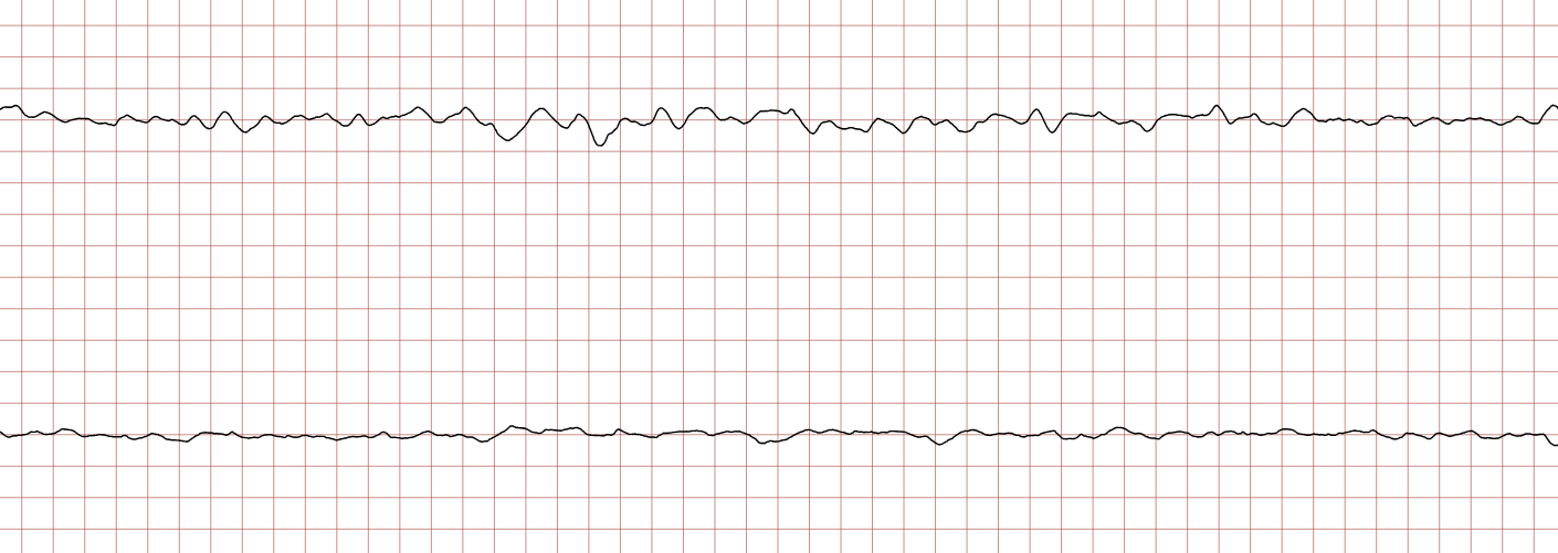 Sudden cardiac arrest: Case 1 – The Cardiovascular