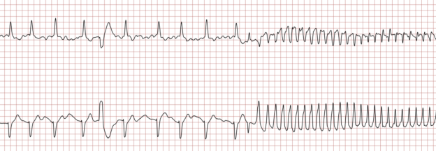 Sudden cardiac arrest: Case 6 – The Cardiovascular