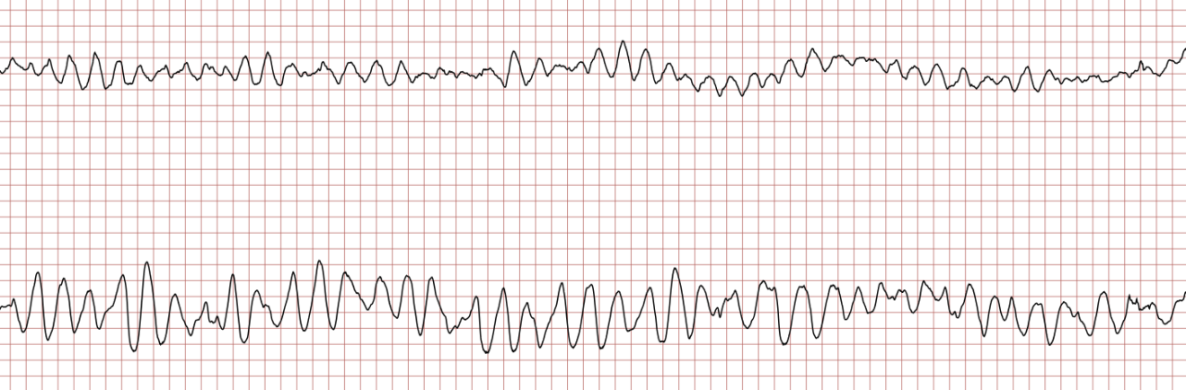 Sudden cardiac arrest: Case 6 – The Cardiovascular