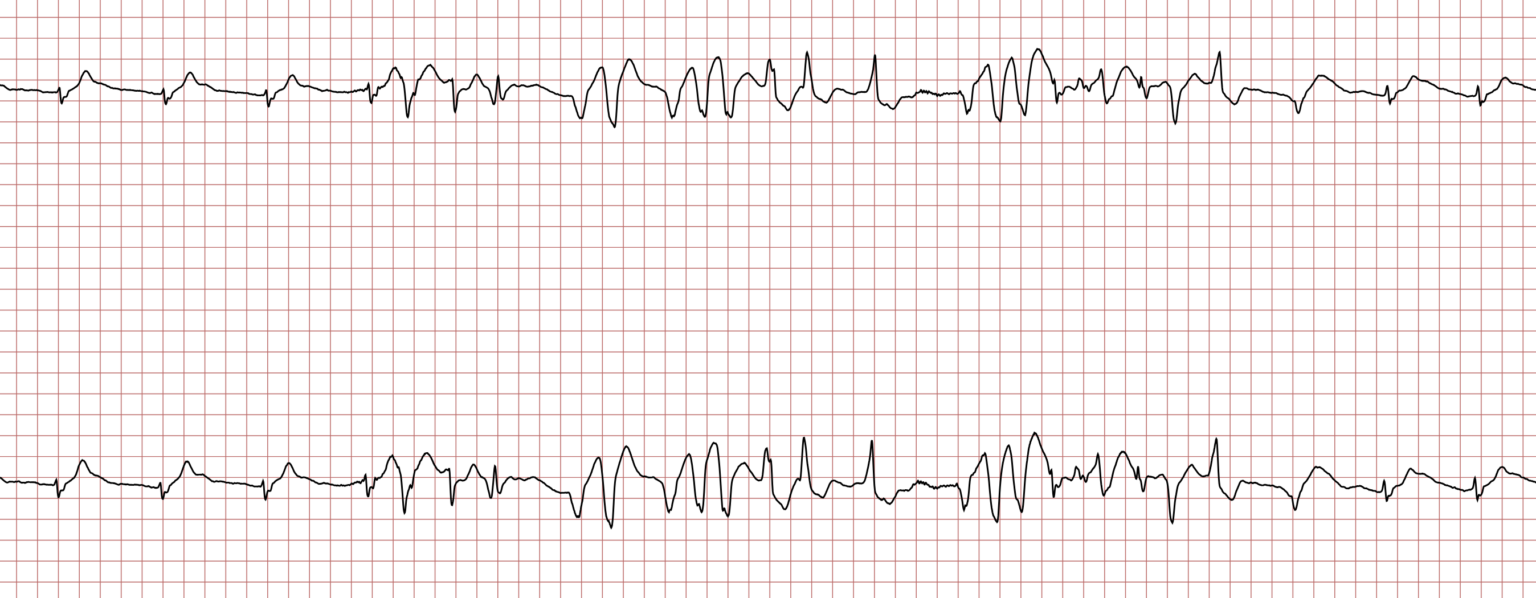 Sudden cardiac arrest: Case 8 – The Cardiovascular