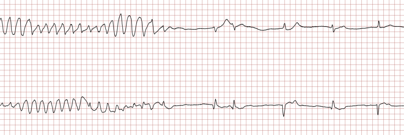Sudden cardiac arrest: Case 7 – The Cardiovascular