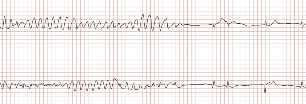 Sudden cardiac arrest: Case 7 – The Cardiovascular
