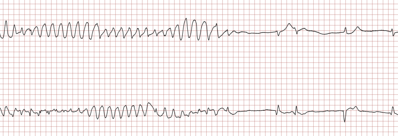 Sudden cardiac arrest: Case 7 – The Cardiovascular