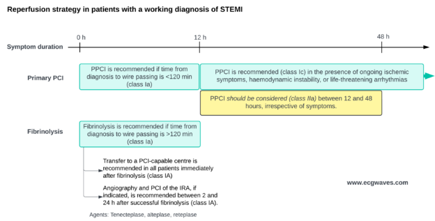 STEMI (ST Elevation Myocardial Infarction): Diagnosis, ECG, Criteria ...