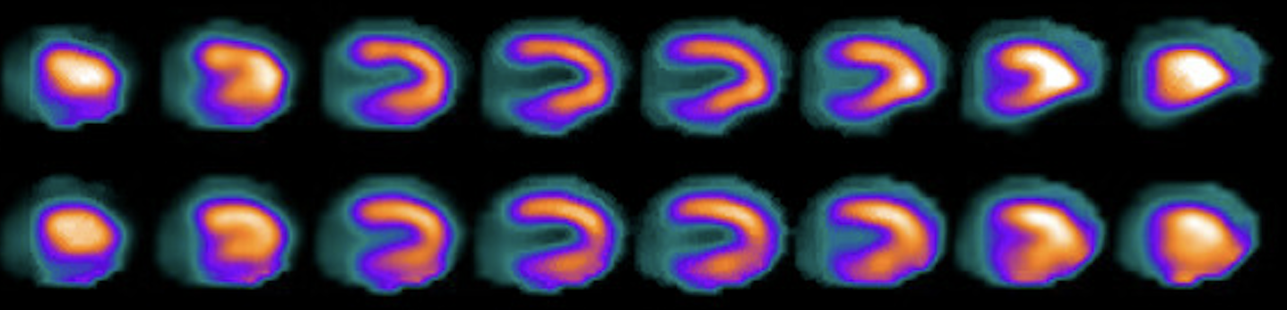 Principles of myocardial perfusion imaging (SPECT, PET), coronary blood ...