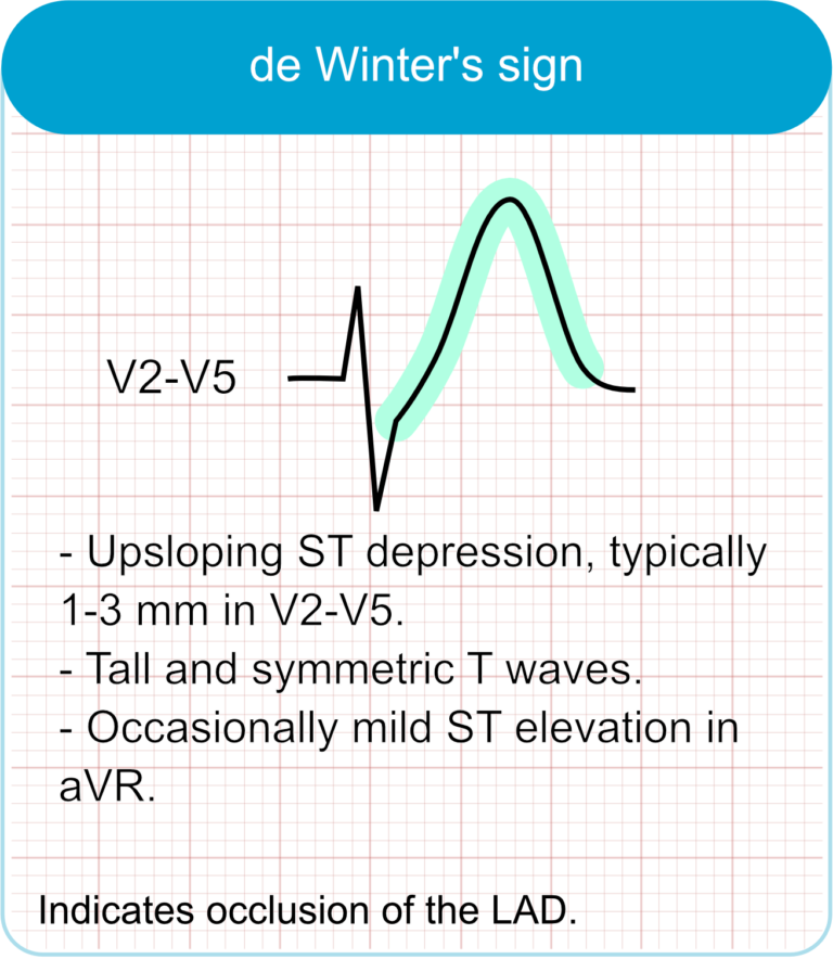 A New Approach to Acute Coronary Syndromes: Occlusion MI (OMI) vs. non ...