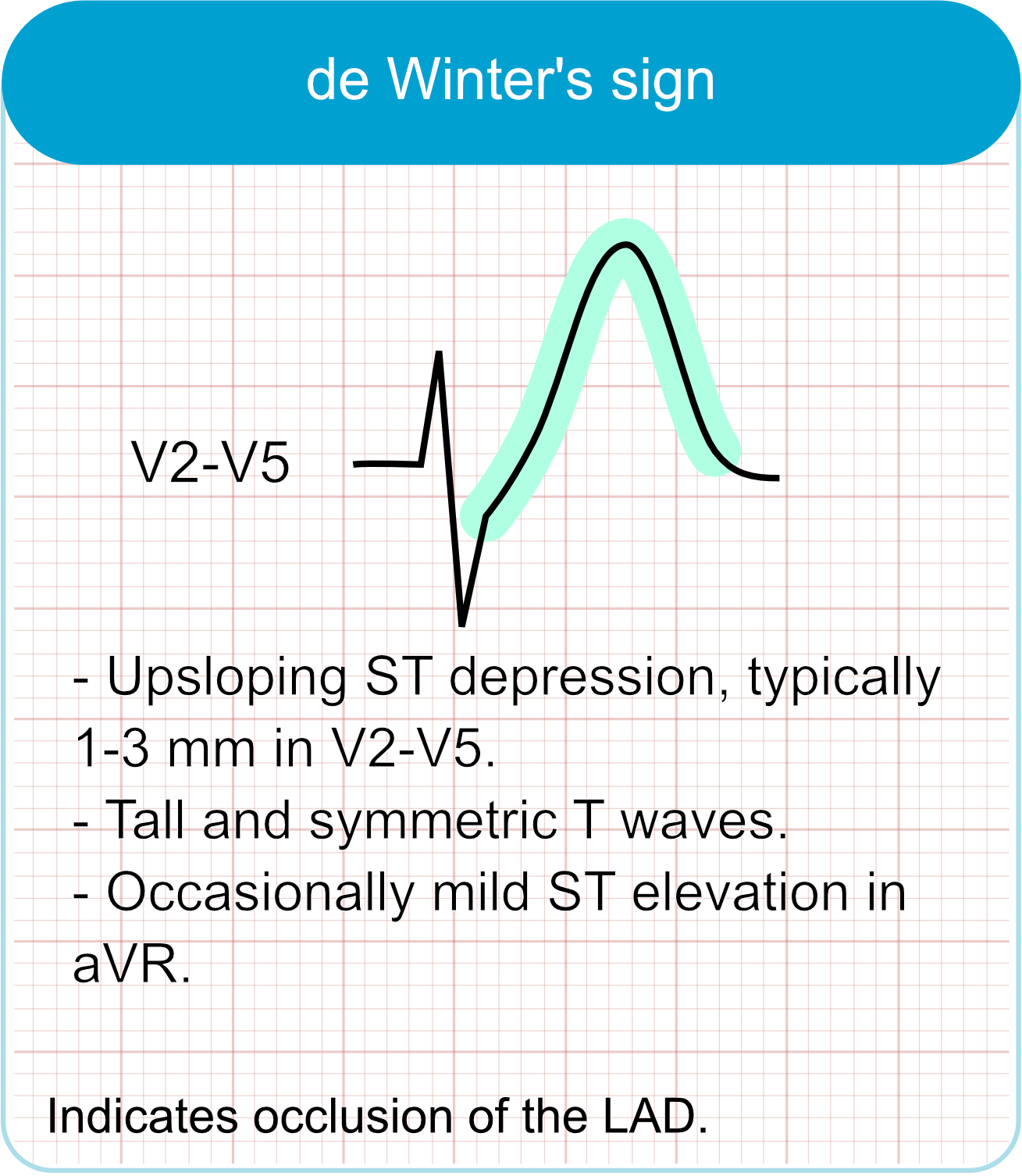 A New Approach to Acute Coronary Syndromes: Occlusion MI (OMI) vs. non ...