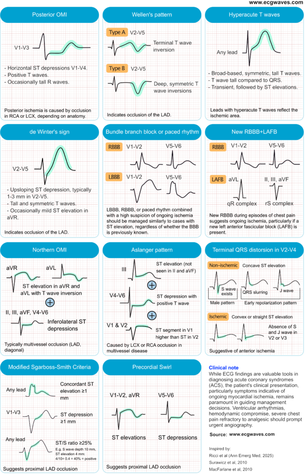 A New Approach to Acute Coronary Syndromes: Occlusion MI (OMI) vs. non ...